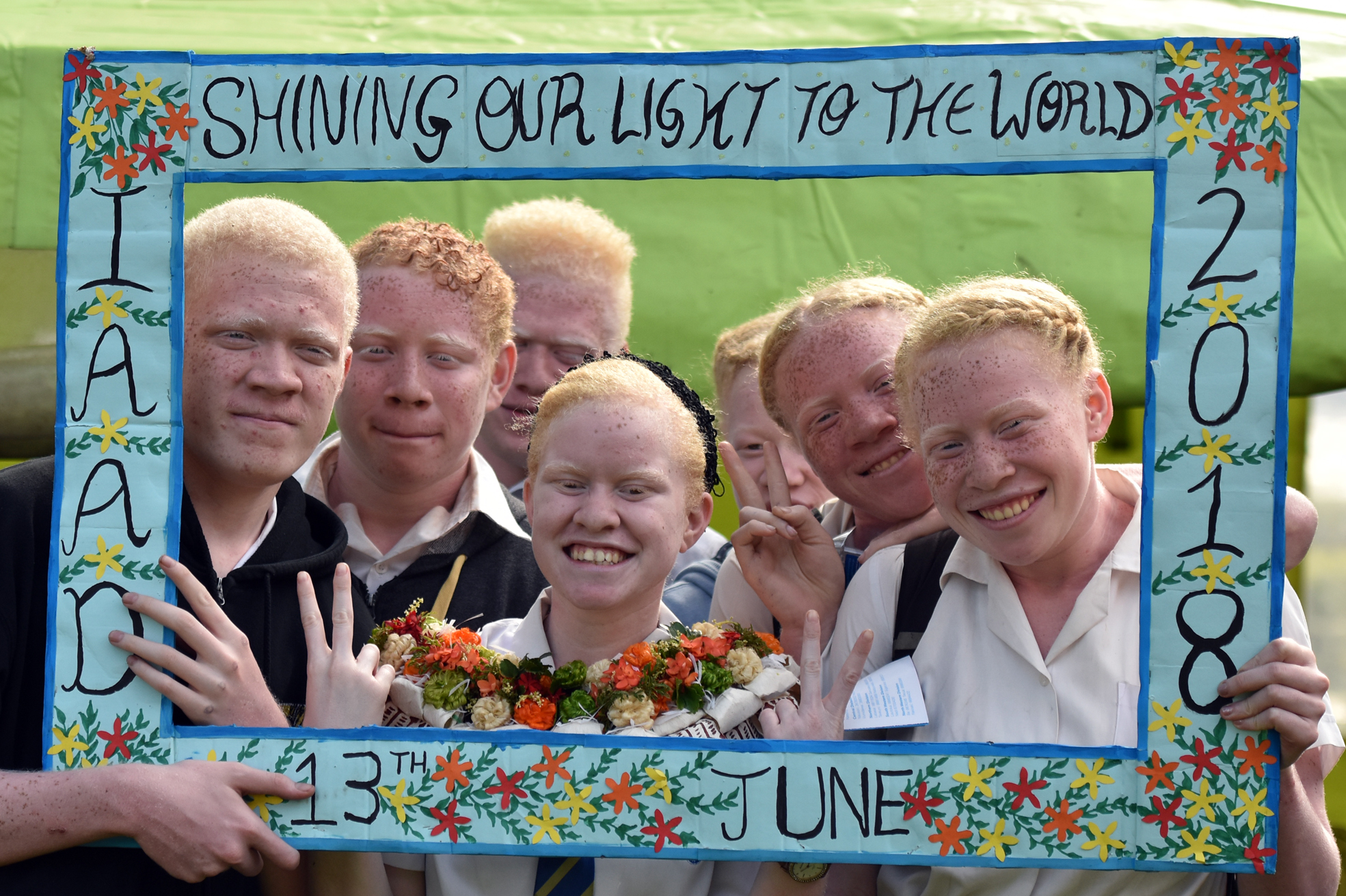 Do not discriminate against albinism - The Fiji Times
