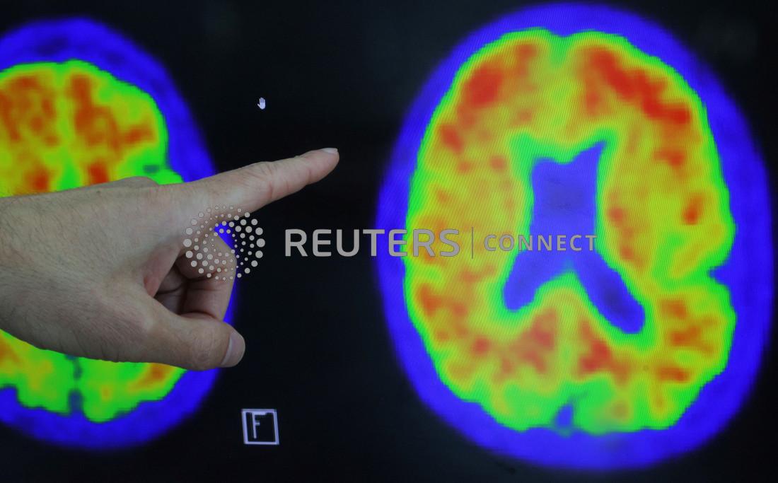 US to build $300 million database to fuel Alzheimer's research - The ... US to build $300 million database to fuel Alzheimer's research - The ...