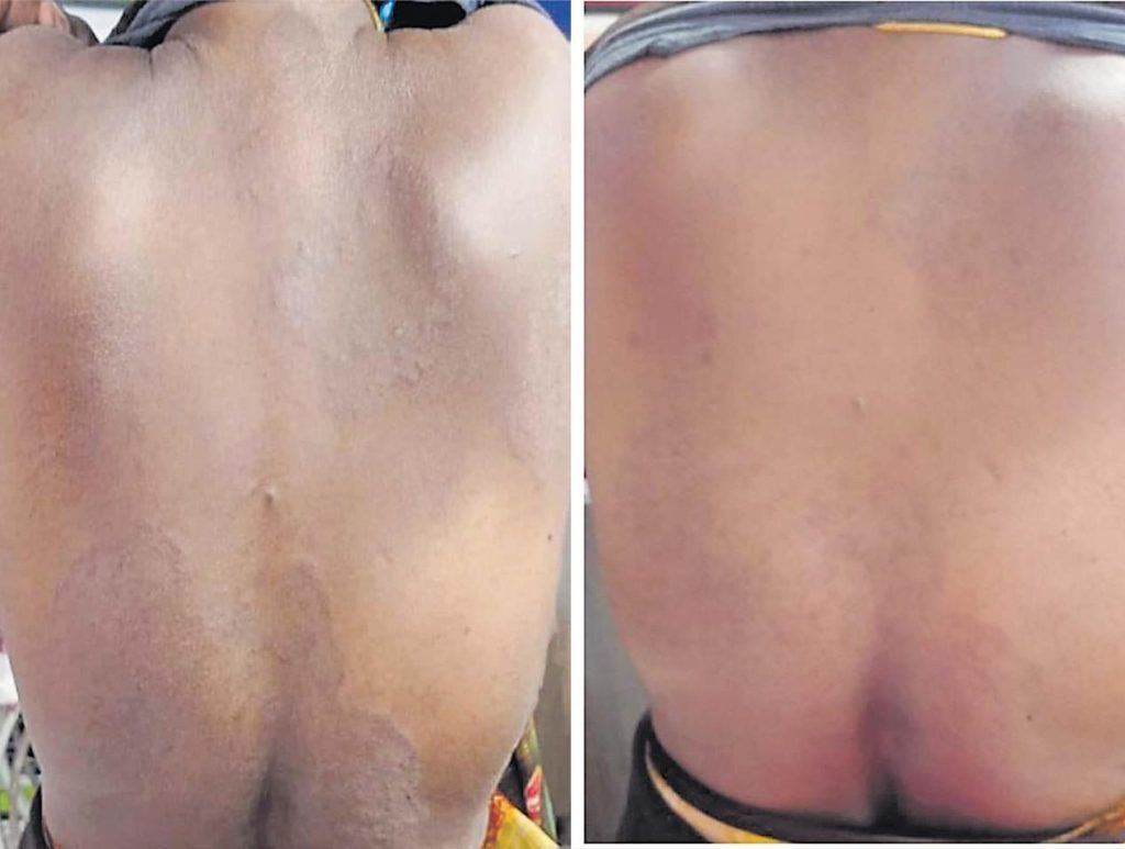 Superficial fungal infection | Tinea corporis in a 45-year-old female patient - The Fiji Times